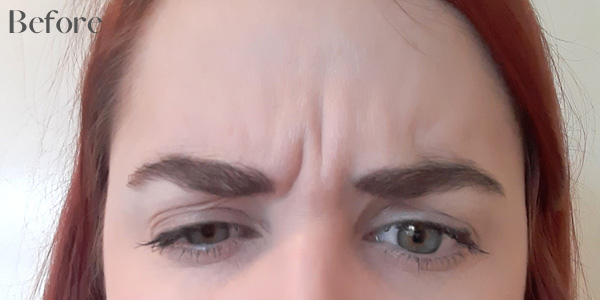 Botox™: Frozen Face Syndrome – Dispelling Myths - Facial Rejuvenation ...