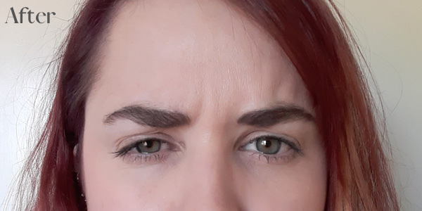 Botox™: Frozen Face Syndrome – Dispelling Myths - Facial Rejuvenation ...